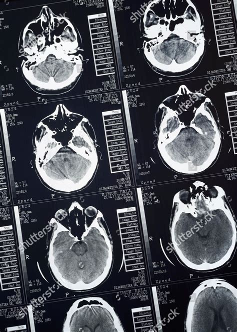 Ct Scan Human Male Brain Close Editorial Stock Photo Stock Image Shutterstock