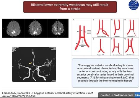 Stroke Azygous Akinetic Paraplegia Incontinence Amnesia Apathy… Sahariar Hossain Siddik