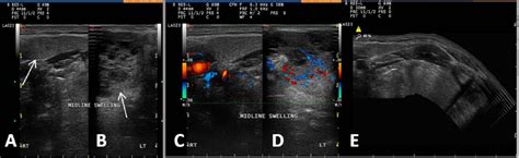 Midline Ectopic Thyroid Mimicking As A Thyroglossal Duct Cyst Manju Bala Popli Arun Chaudhary