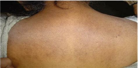 Hyperpigmentation On Back