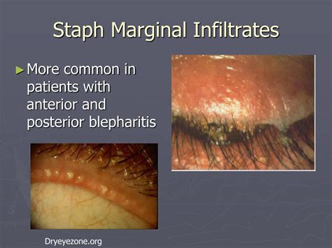 Ppt Lasik Complications Powerpoint Presentation Free Download Id