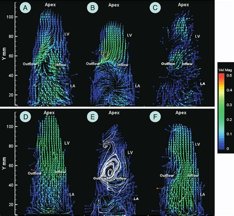 Digital Particle Image Velocimetry Profiles Of Lv Flow During Phases Of