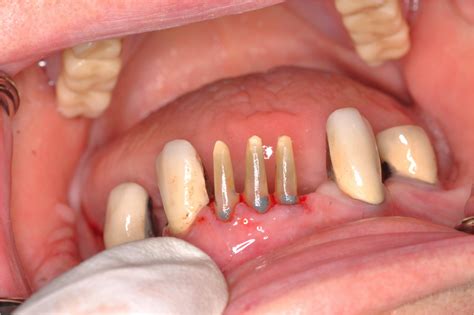 Dental Info So Many Choices For Crown Preparation Designs