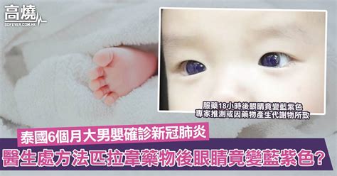 【新冠肺炎藥物】泰國6個月大男嬰確診新冠肺炎！醫生處方法匹拉韋抗病毒藥物！服藥後眼睛竟變藍紫色？