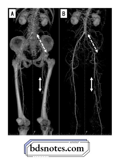 Lower Limb Ischaemia Bds Notes