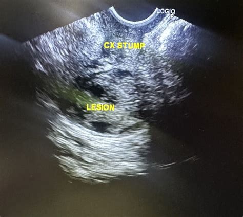 A 42 Year Old Female With A History Of Multiple Uterine Fibroids Underwent Total Abdominal