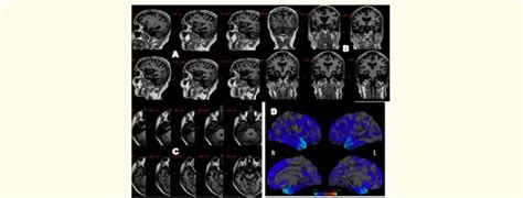 Diffuse Cortical Atrophy Predominantly In The Temporal Lobes On Mri