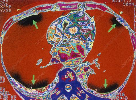 Asbestosis Ct Scan Stock Image M1080605 Science Photo Library