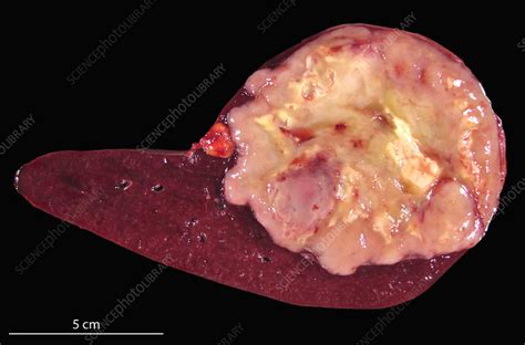 Cholangiocarcinoma Gross