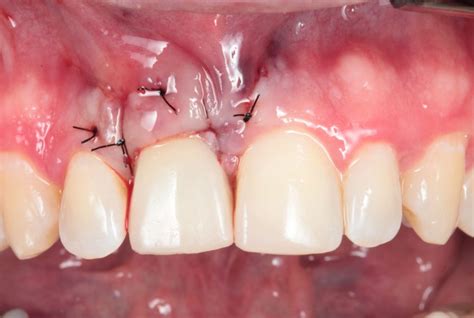 Immediate Implant With Immediate Provisioning And Connective Tissue Graft A Case Report Fgm