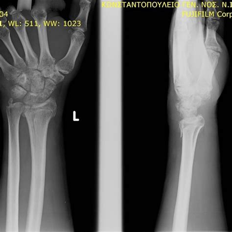 Scaphoid Fracture Classification According To Herbert And Fischer Download Scientific Diagram