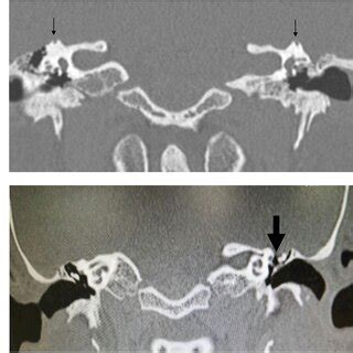 A Temporal Bone High Resolution Computed Tomography CT Coronal View Download Scientific