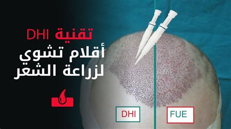 Choi Pen Technique Hair Transplantation Plastic Surgery In Istanbul
