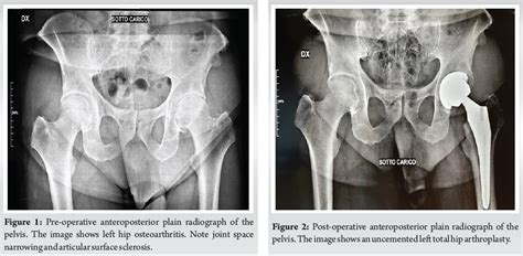 A Rare Case Of Staphylococcus Caprae Periprosthetic Hip Infection With Unusual Clinical