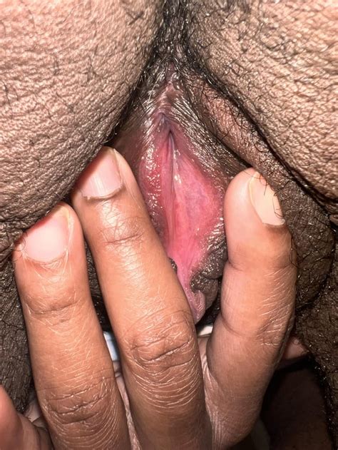 Vaginectomy With The Crane Center R Phallo