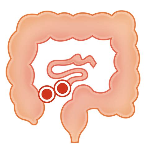 Journal Articles Ileostomy And Internal Pouch Association