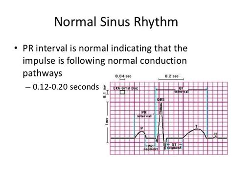 Normal Sinus Rhythm