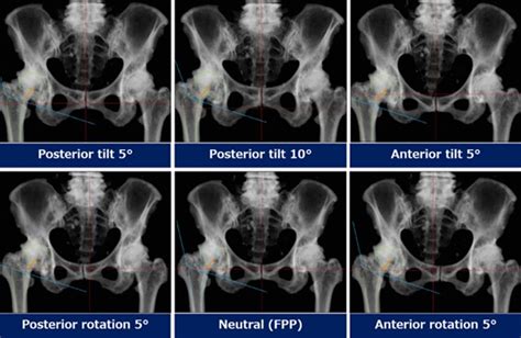 Several Patterns Of Digitally Reconstructed Radiographs Of The Pelvis Download Scientific