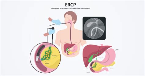 Why Should Ercp Be Performed At Bangkok Hospital Bangkok Hospital Headquarter