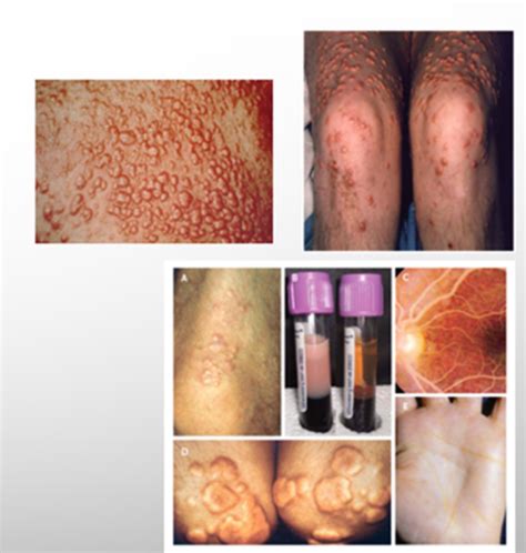 Lipoprotein Disorders Flashcards Quizlet
