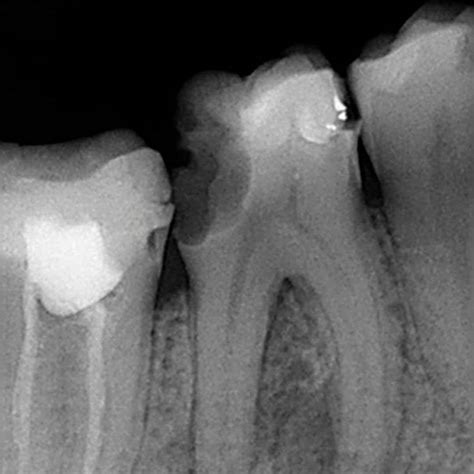 What Do Dental X Rays Tell You About Your Oral Health Primary Dental