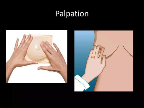 Benign Breast Diseases Pptx