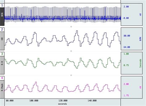 Ecg Cardiology Online Ecg Analysis Heart Rate And Inter Beat
