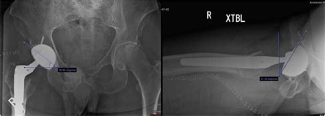 After Revision Tha The Acetabular Component Anteversion And Abduction Download Scientific