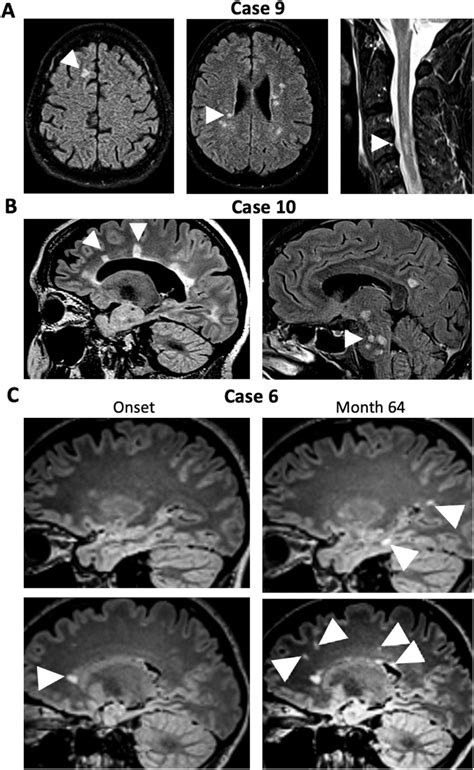 Frequency Characteristics And Immunological Accompaniments Of Ataxia