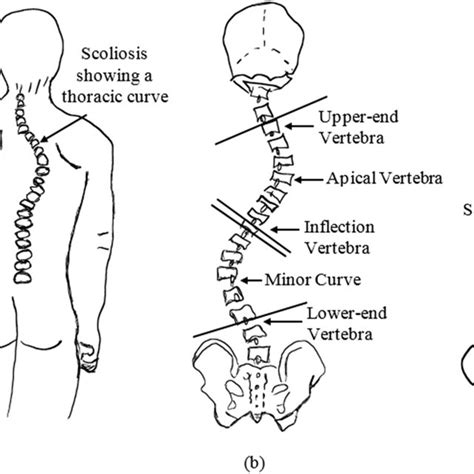 Scoliosis Views A Normal Versus Scoliotic Spine B Definition Of Download Scientific