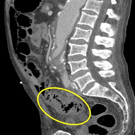 Contrast Enhanced Sagittal Image Demonstrates Diffuse Circumferential Download Scientific