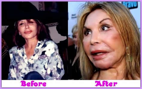 Elsa Patton Plastic Surgery Gone Wrong Before And After Botox