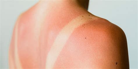 Worst Sunburn Blisters