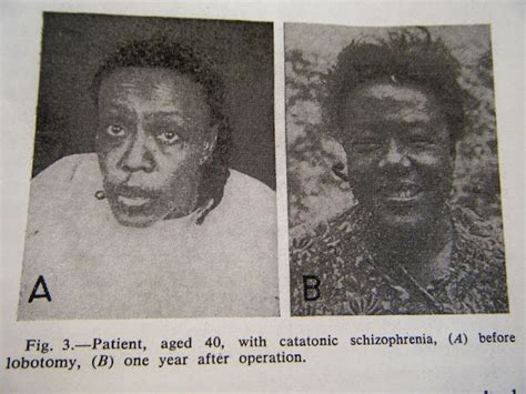 Do You Need A Lobotomy Just Look At The Results From These Before And After Photo Comparisons
