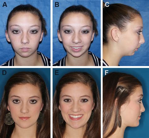 Surgical Correction Of The Severe Jaw Deformity In Teenagers With Juvenile Idiopathic Arthritis