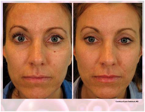 Prp Facial Near Me Prp Facial Treatment Prp Facial Benefits