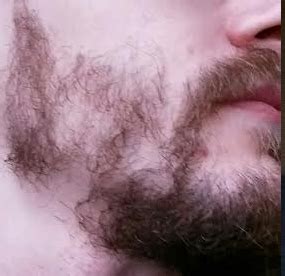 Patchy Beard Success Stories Before And After Photos Page Beard Board