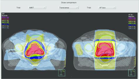A Side By Side Comparison Of The Relative Dosimetries Between An IMRT Download Scientific