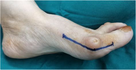 The Medial Incision Is Made Parallel To The Plantar Surface Of The Download Scientific Diagram