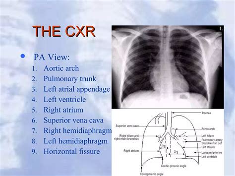 How To Read Cxr Ppt