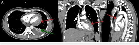 A Ct Pe Protocol Transverse View Of Thorax On January 2022 Red Arrow
