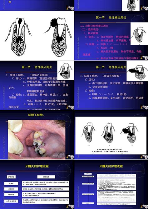 牙髓炎临床表现及护理ppt模板 卡卡办公