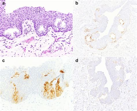 A Prostatic Metaplasia Is Characterized By Patchy Glandular Download Scientific Diagram