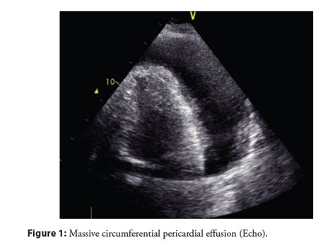 Constrictive Pericarditis Echo