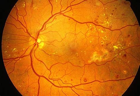 Diabetic Retinopathy Health Vision Health Read This Story On