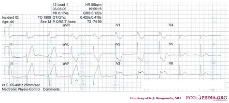 Posterior Myocardial Infarction Wikidoc