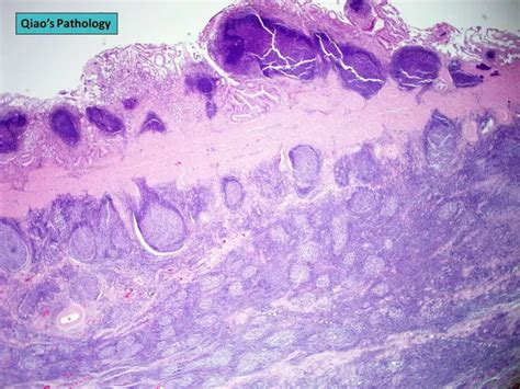 Follicular Cholecystitis