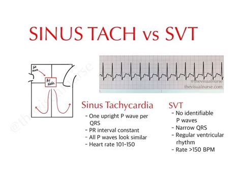 Supraventricular Tachycardia Vs Sinus Tachycardia Sinus Rhythm Vs