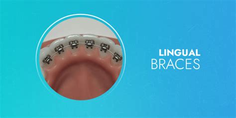Lingual Braces Eswar Dental Clinic