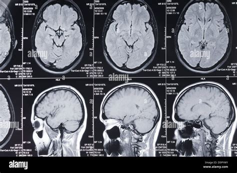 Closeup Of A Computer Axial Tomography Scan CAT Scan Of A Head Stock Photo Alamy